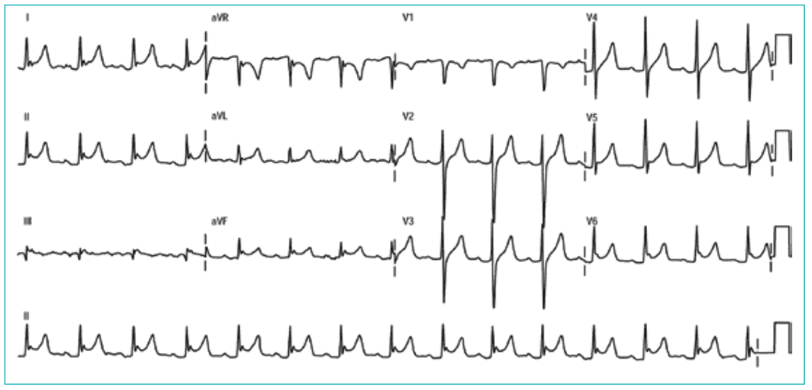¿Qué es la Pericarditis? Síntomas y Tratamiento | Medicine Books